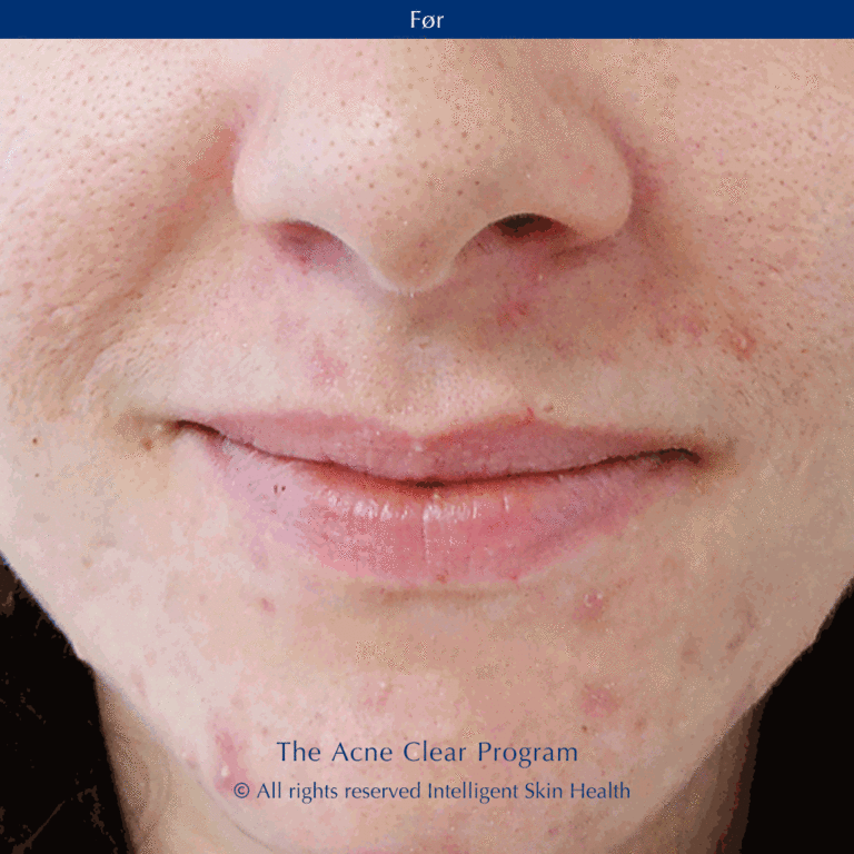 Akne behandling - Elite Helse Oslo Tjuvholmen - Hudeksperter, Juvederm ...